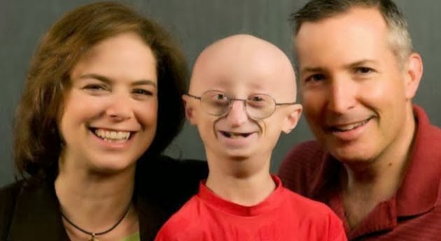 Progeria